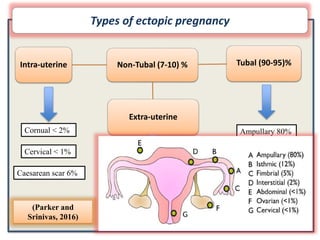 Madical treatment of ectopic pregnancy .Prof. Salah Roshdy | PPSX