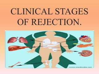 TRANSPLATATION REJECTION STAGES. | PPT
