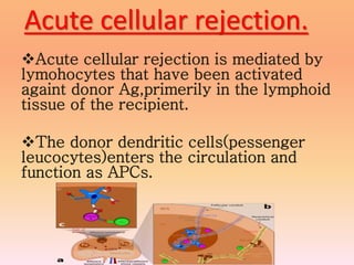 TRANSPLATATION REJECTION STAGES. | PPT