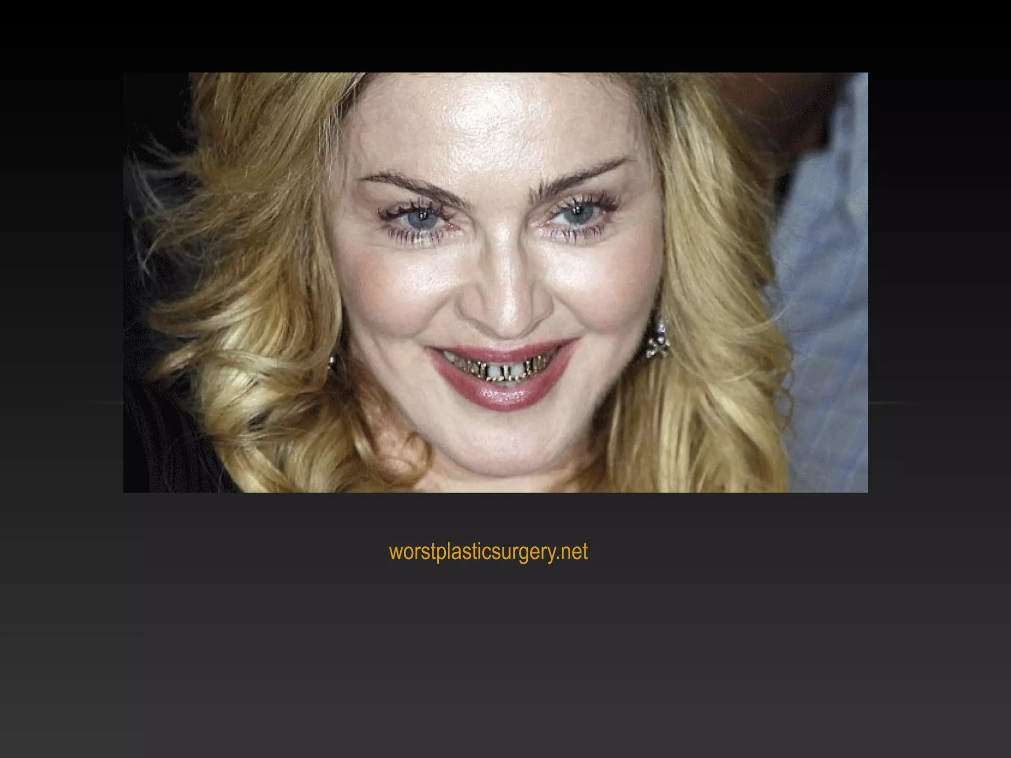 Madonna Plastic Surgery-Madonna Plastic surgery Before and After | PPT