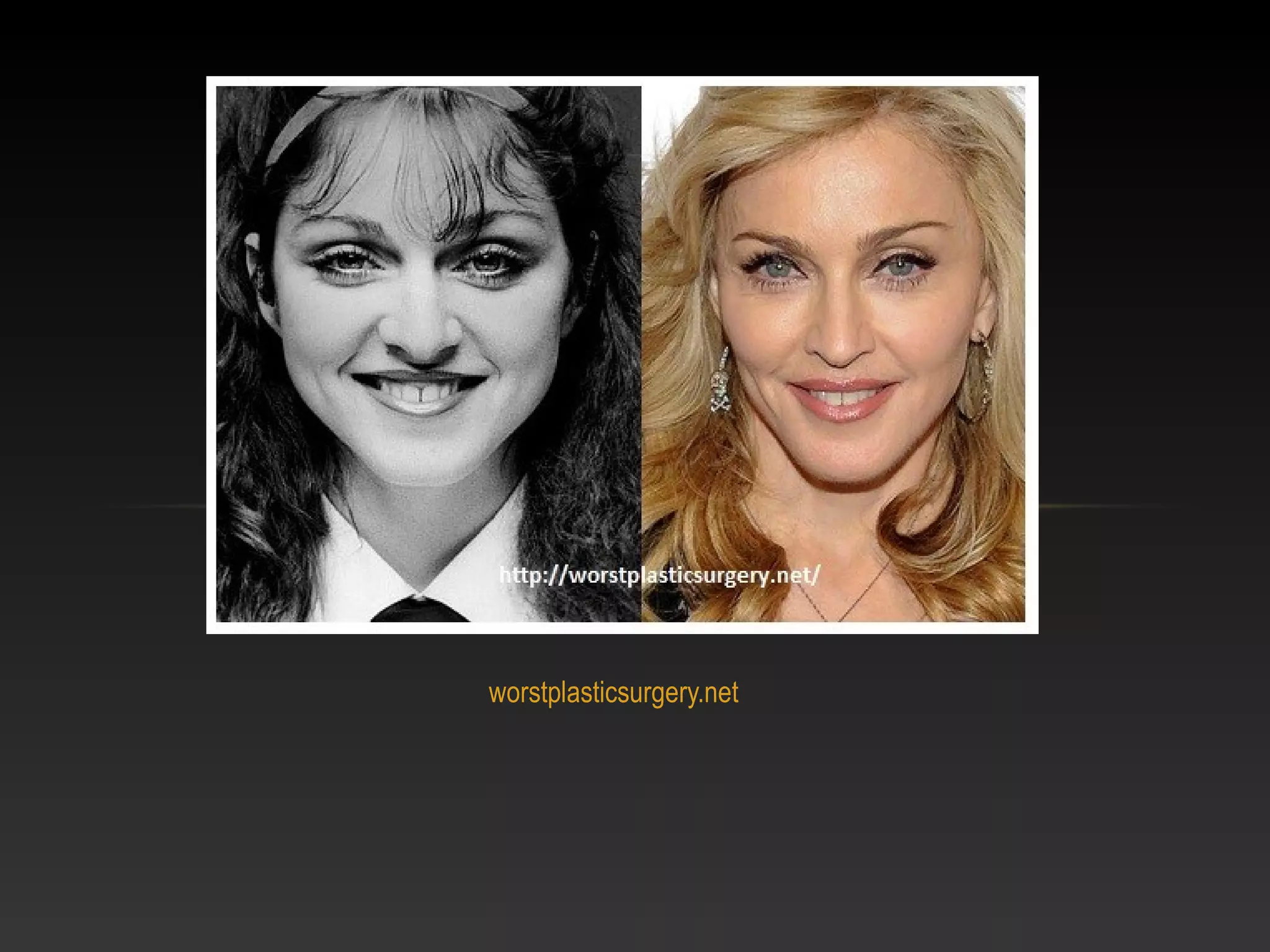 Madonna Plastic Surgery-Madonna Plastic surgery Before and After | PPT