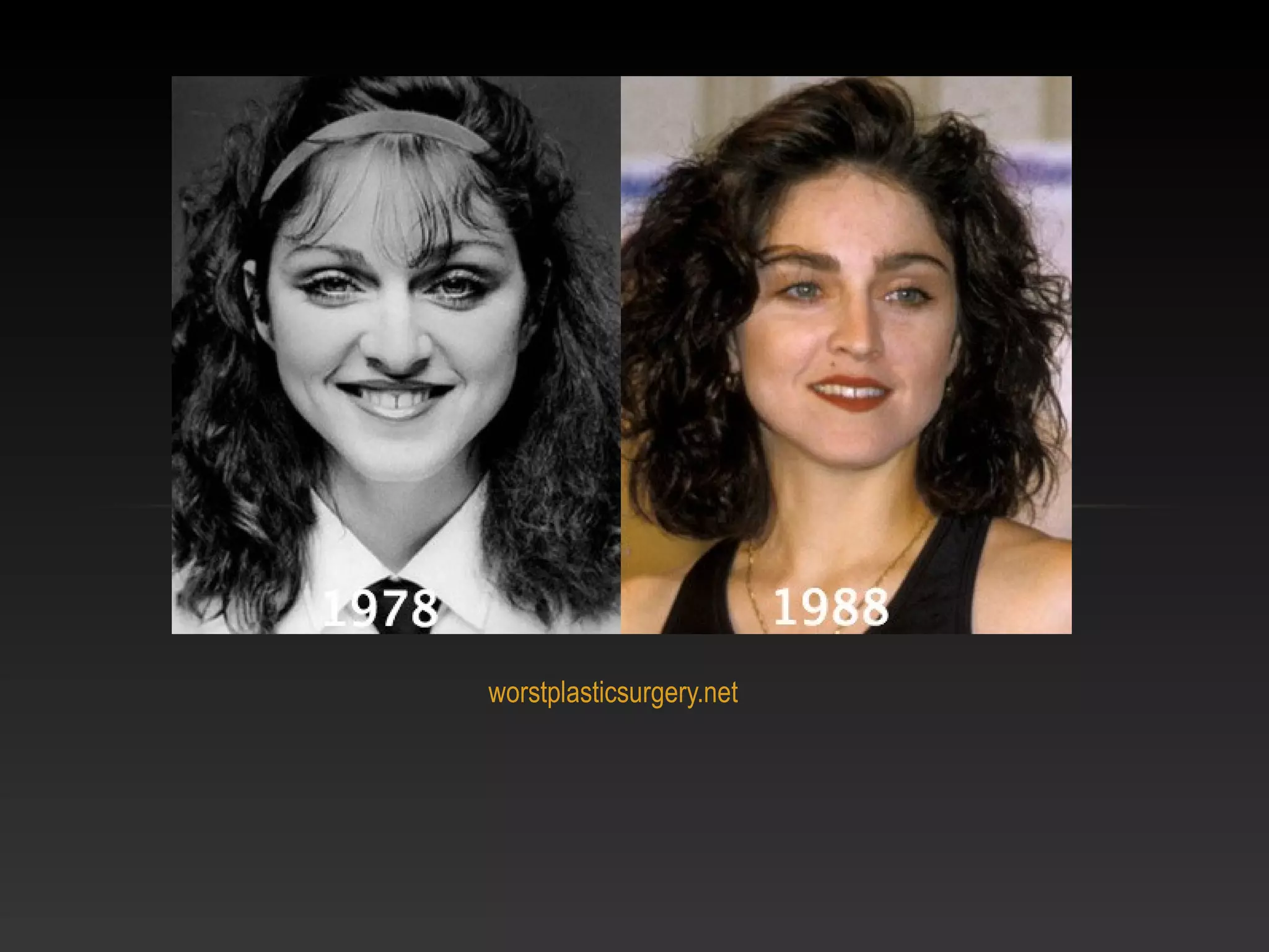 Madonna Plastic Surgery-Madonna Plastic surgery Before and After | PPT
