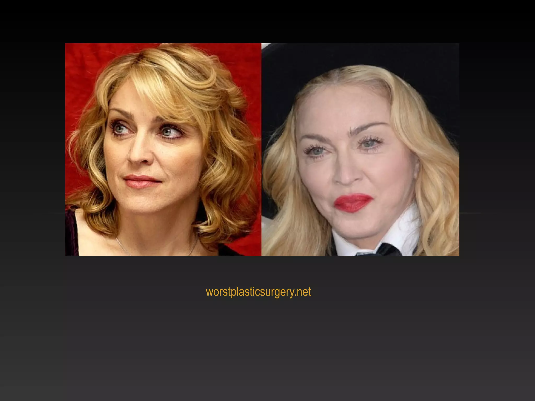Madonna Plastic Surgery-Madonna Plastic surgery Before and After | PPT