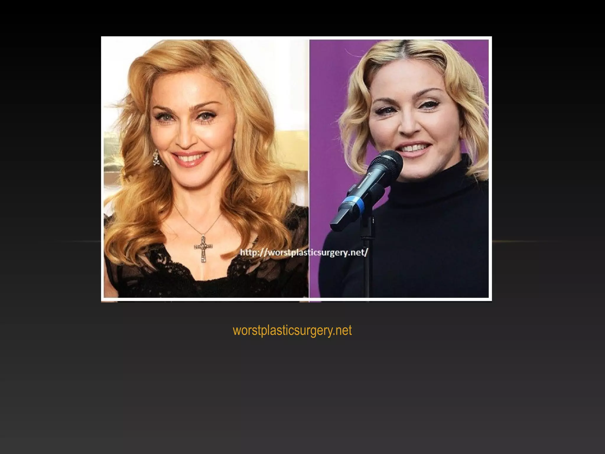 Madonna Plastic Surgery-Madonna Plastic surgery Before and After | PPT