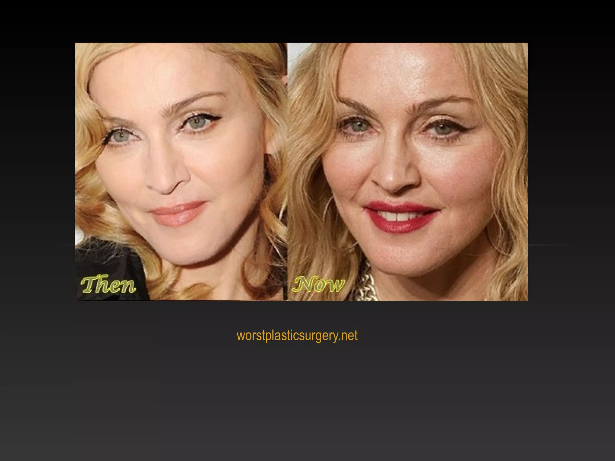 Madonna Plastic Surgery-Madonna Plastic surgery Before and After | PPT