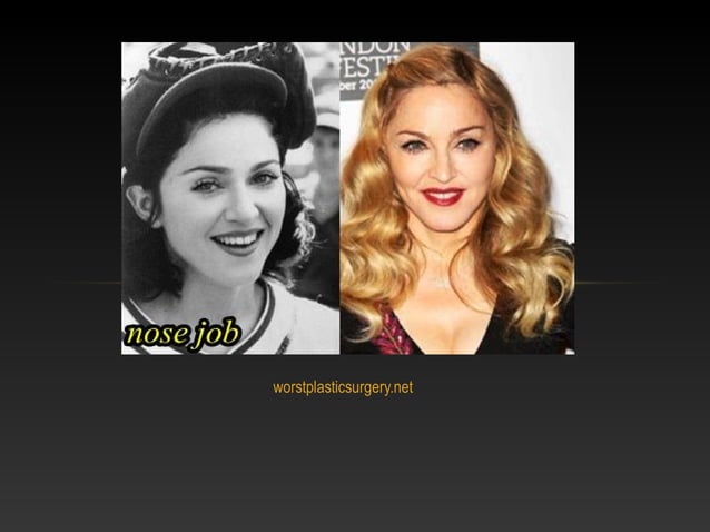 Madonna Plastic Surgery-Madonna Plastic surgery Before and After | PPT