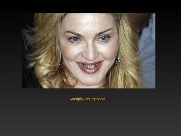 Madonna Plastic Surgery-Madonna Plastic surgery Before and After | PPT