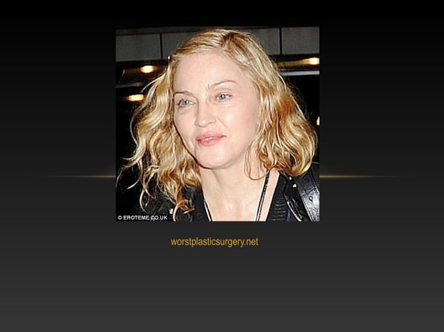 Madonna Plastic Surgery-Madonna Plastic surgery Before and After | PPT