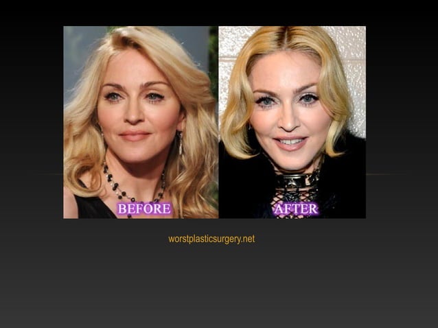 Madonna Plastic Surgery-Madonna Plastic surgery Before and After | PPT