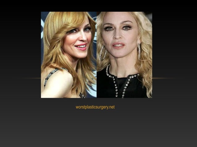 Madonna Plastic Surgery-Madonna Plastic surgery Before and After | PPT