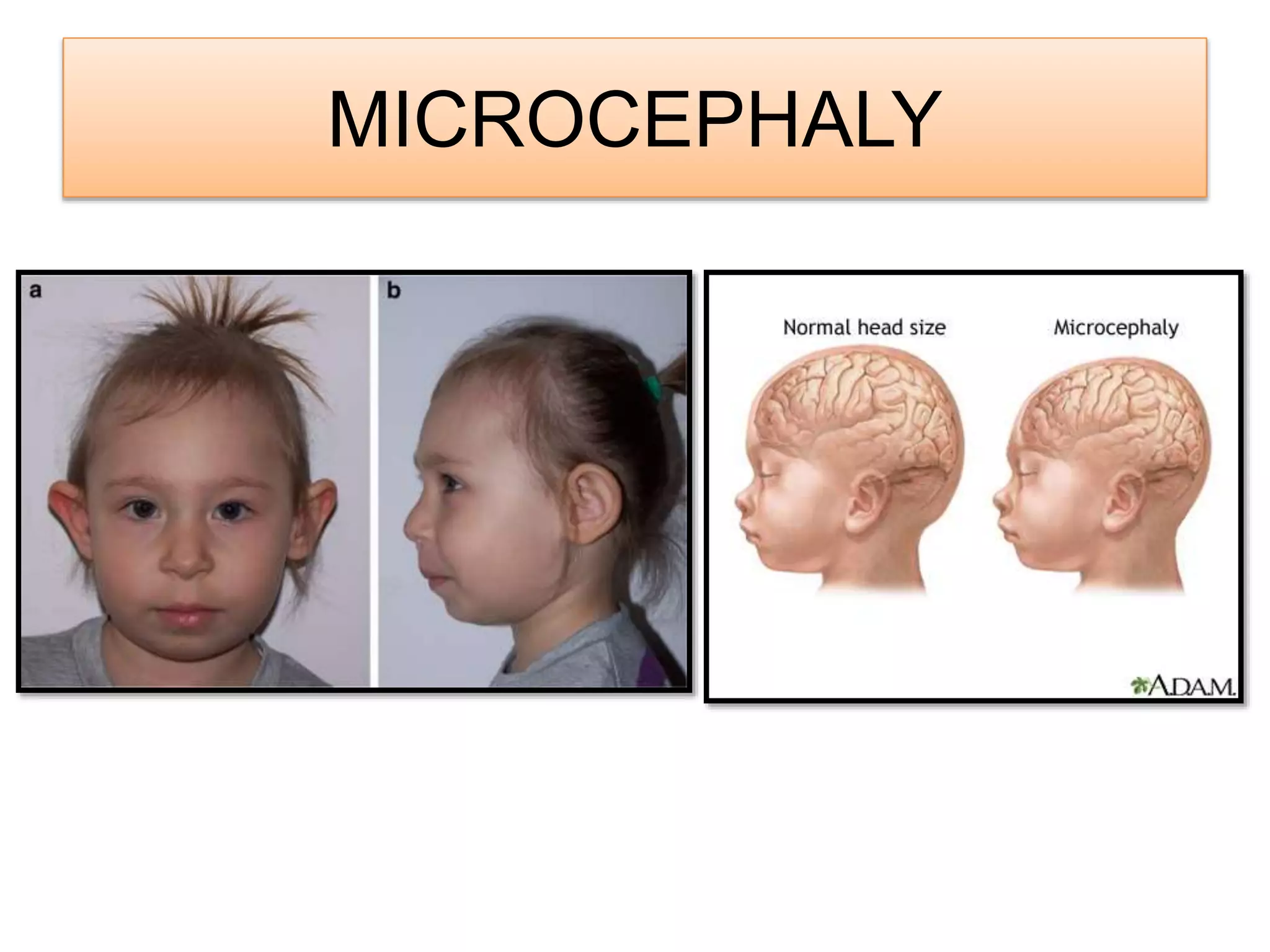 Mental Retardation/Intellectual Disability: Definition and its causes ...