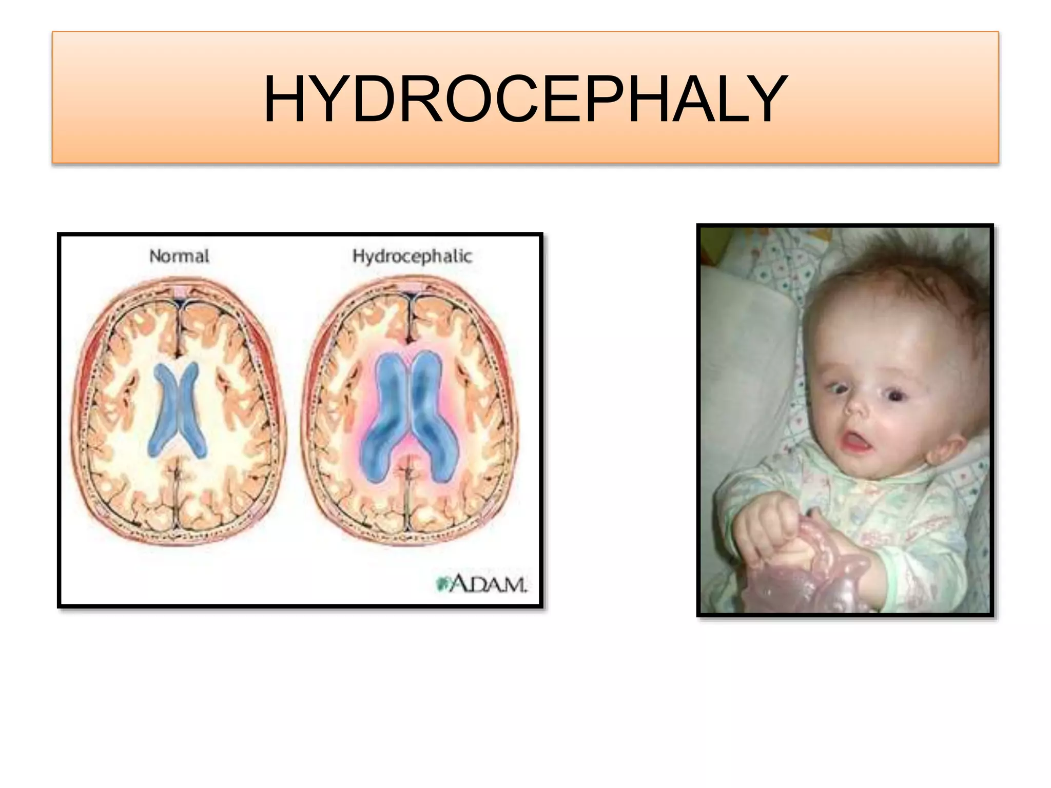 Mental Retardation/Intellectual Disability: Definition and its causes ...