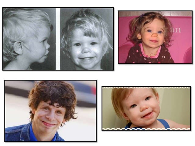 Mental Retardation/Intellectual Disability: Definition and its causes ...