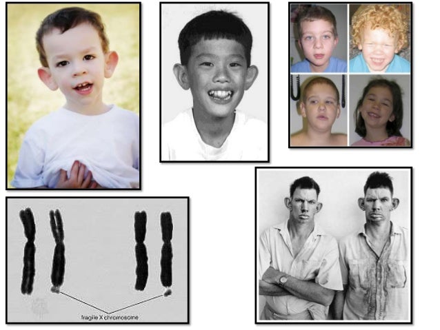 Mental Retardation/Intellectual Disability: Definition and its causes