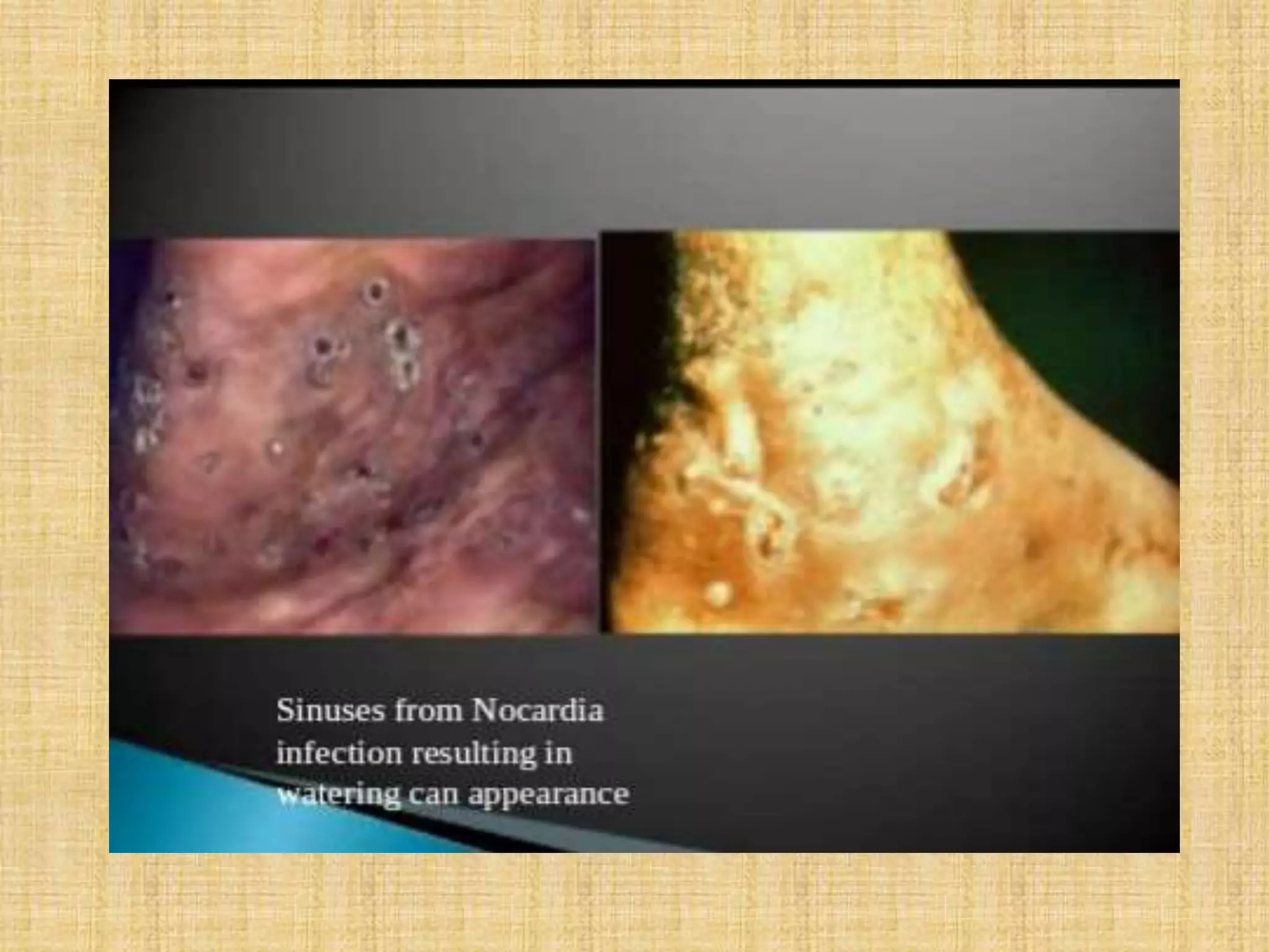 Madura foot ppt | PPTX