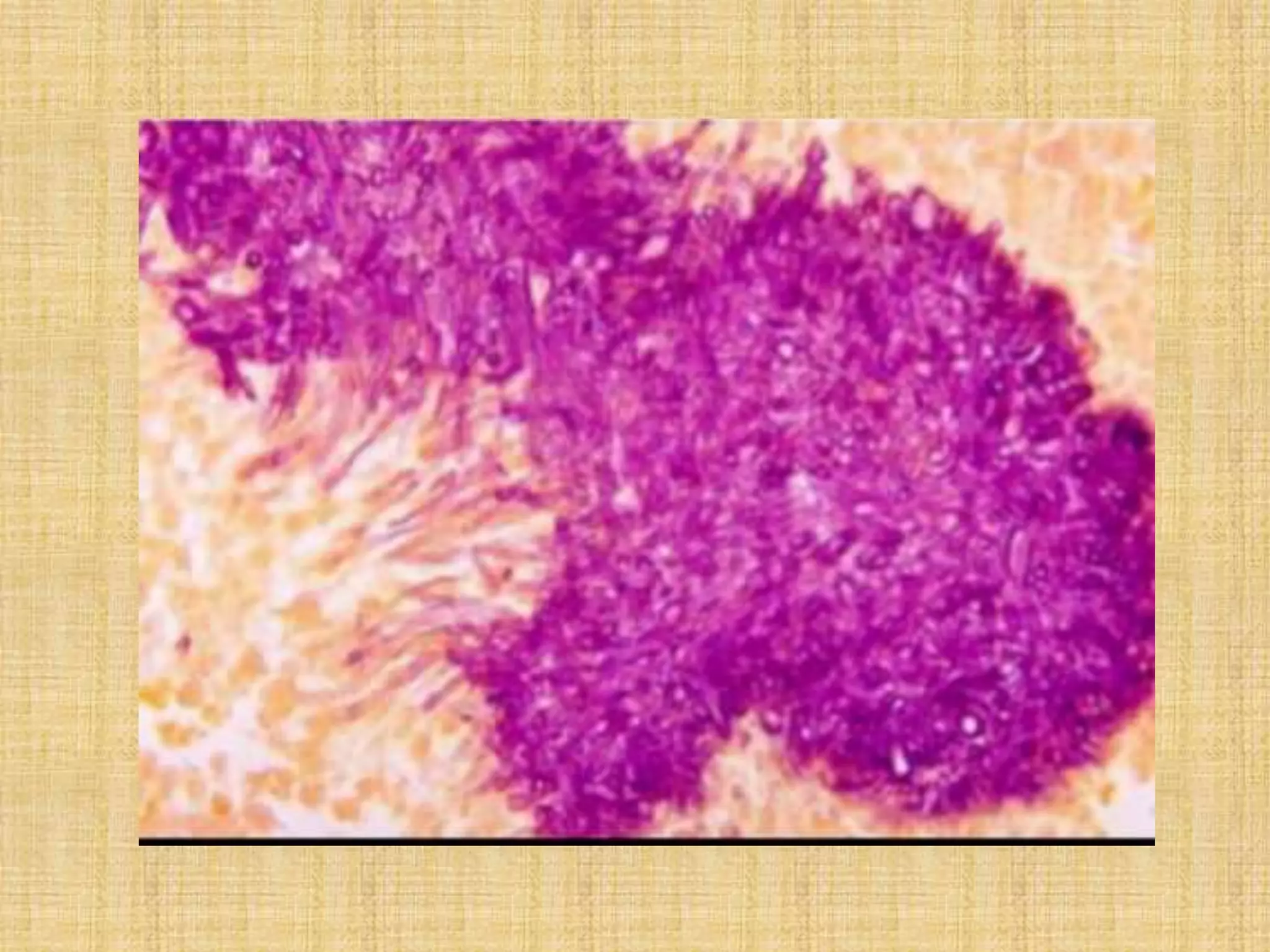 Madura foot ppt | PPTX