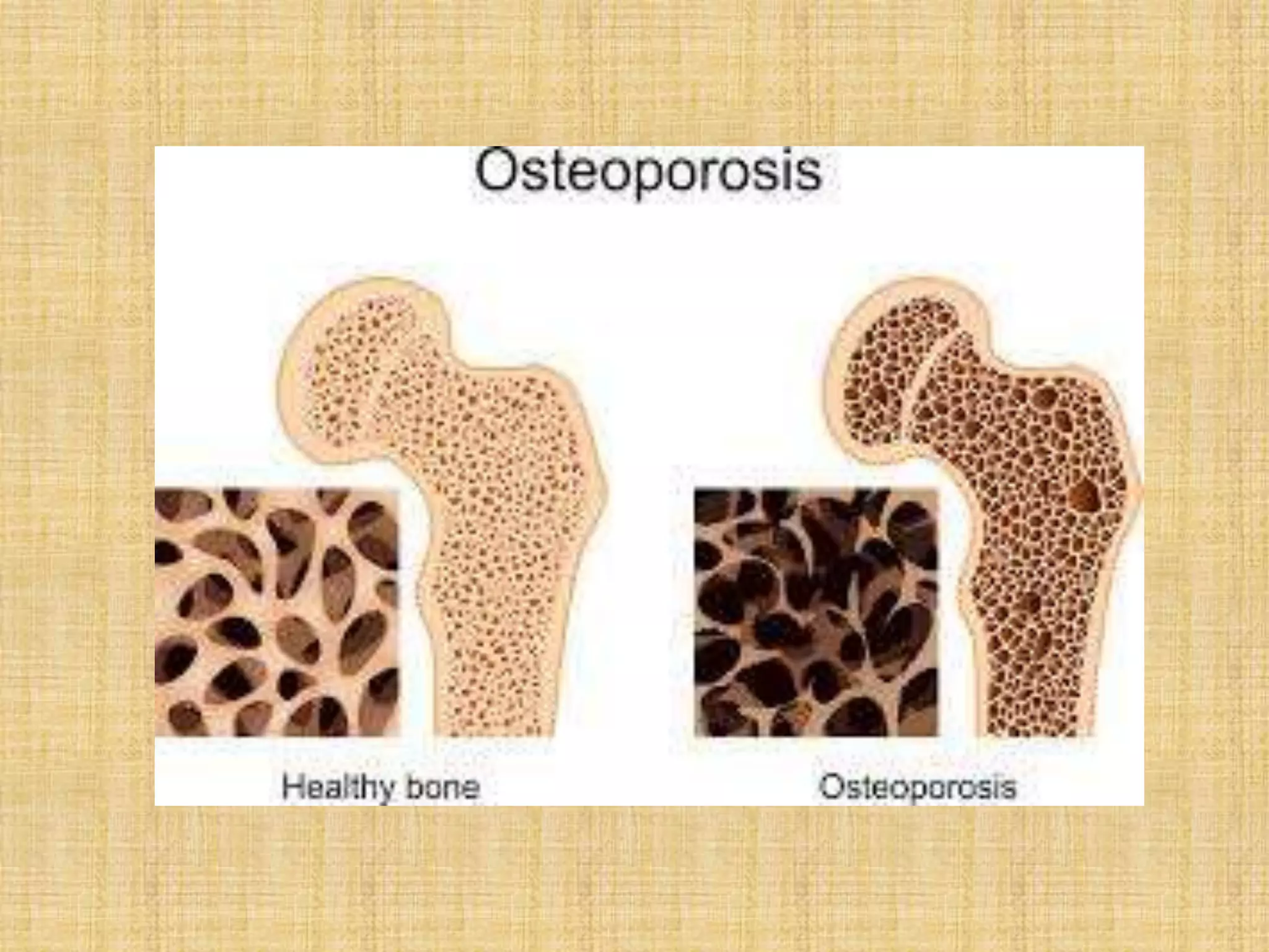 Madura foot ppt | PPTX