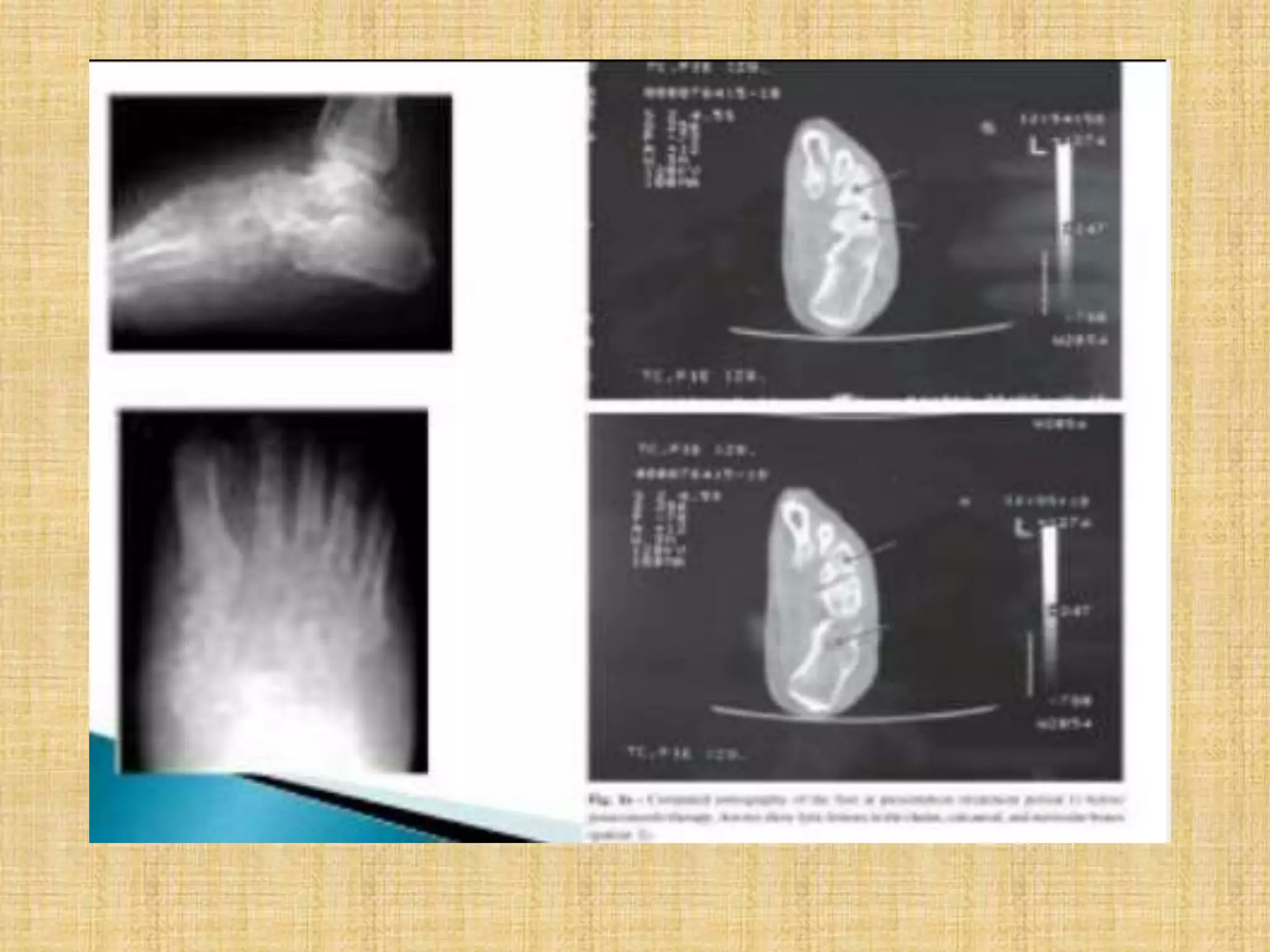 Madura foot ppt | PPTX