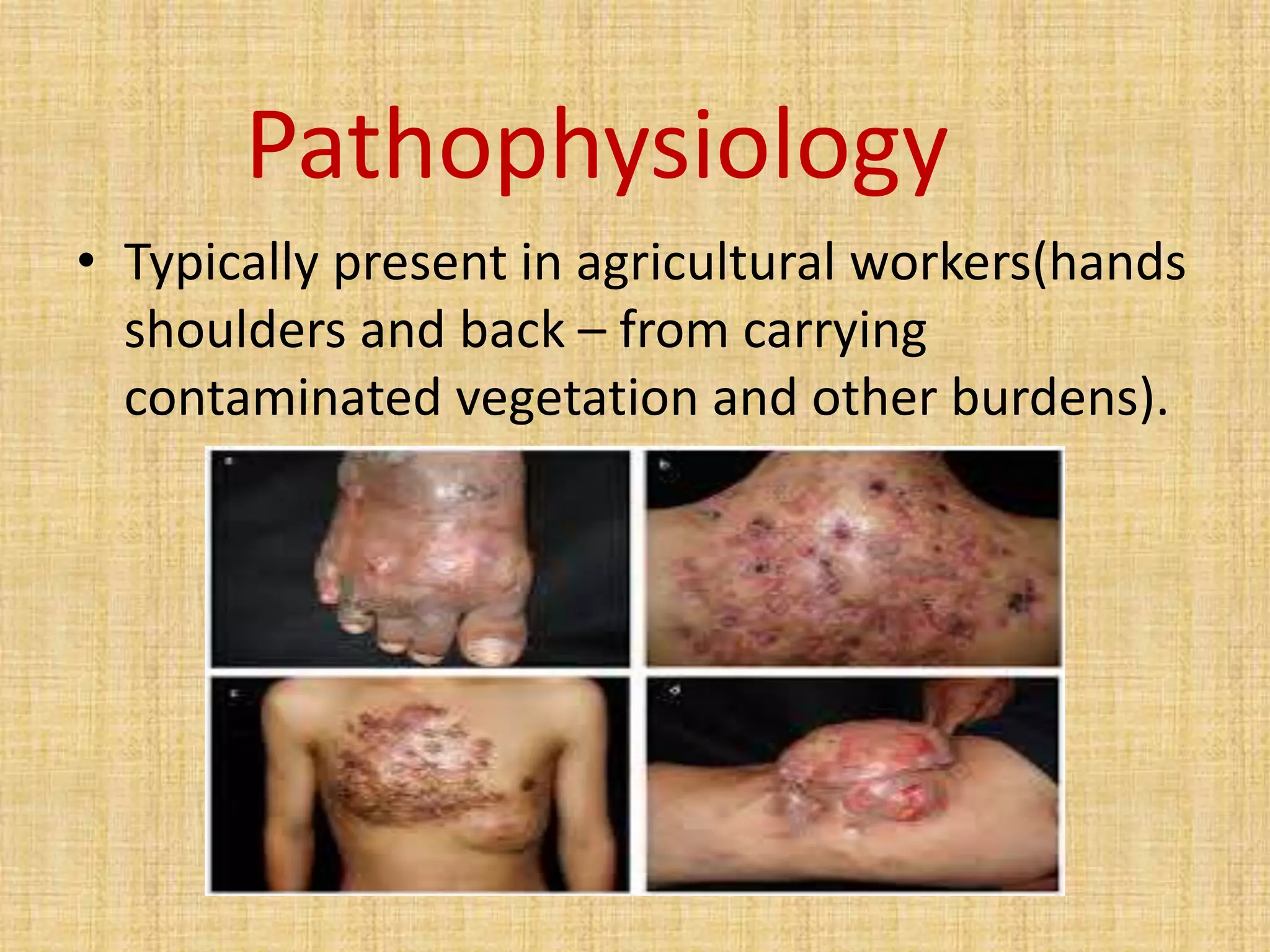 Madura foot ppt | PPTX