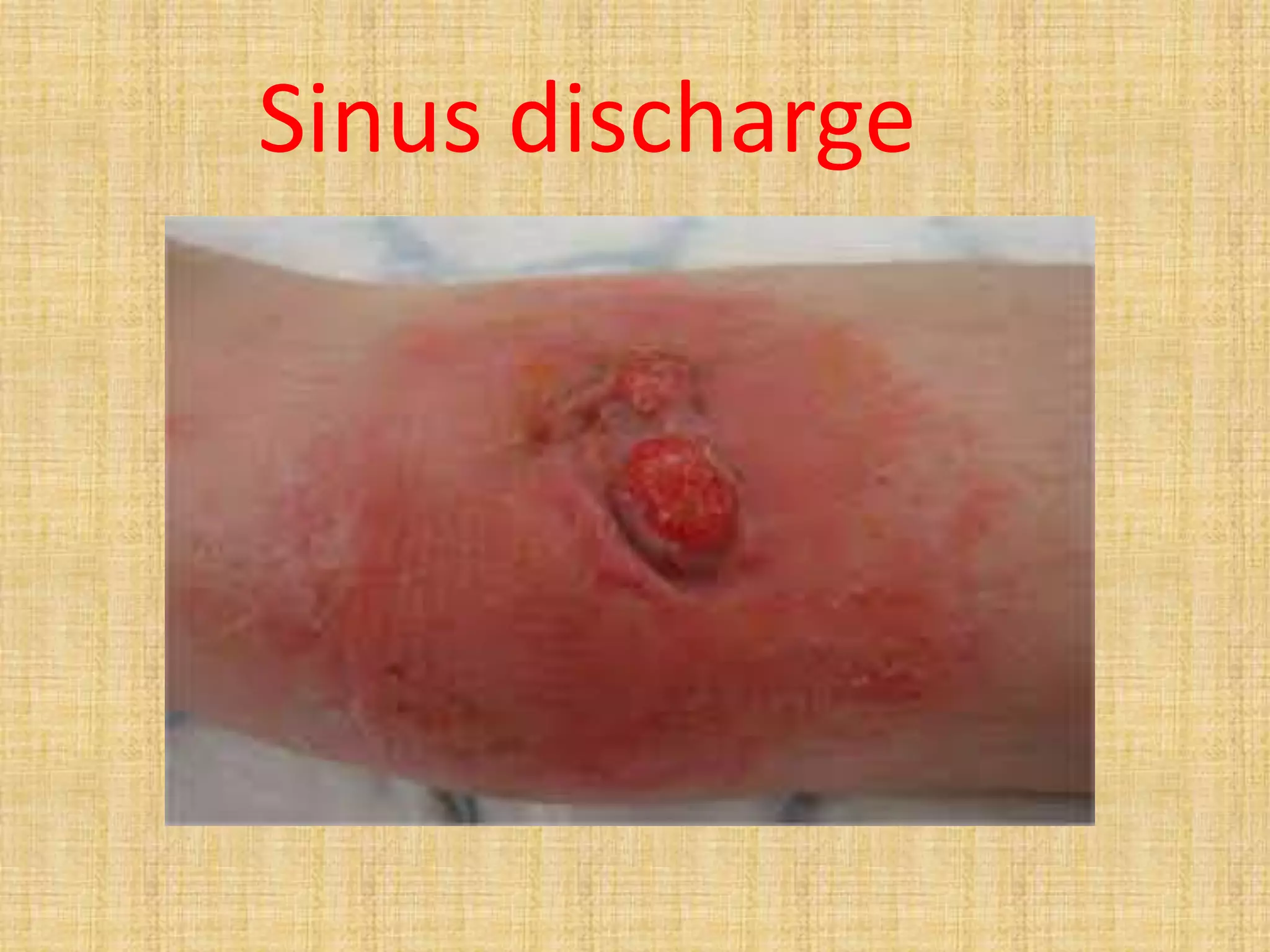 Madura foot ppt | PPTX