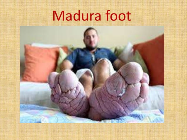 Madura foot ppt | PPTX