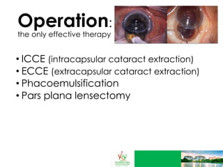 Magement of cataract | PDF