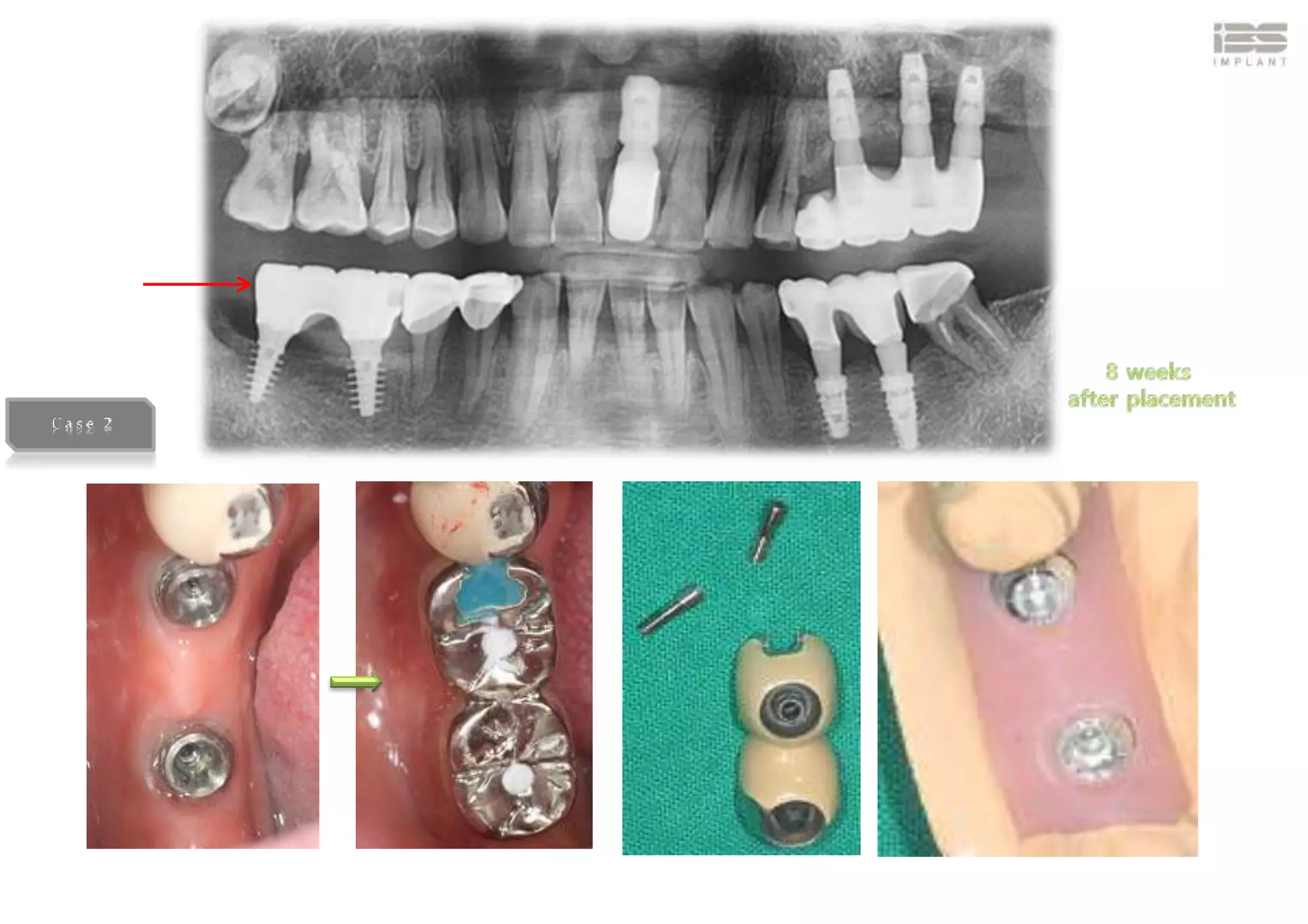 Magicore Clinical Cases. | PPTX | Dental Health | Diseases and Conditions