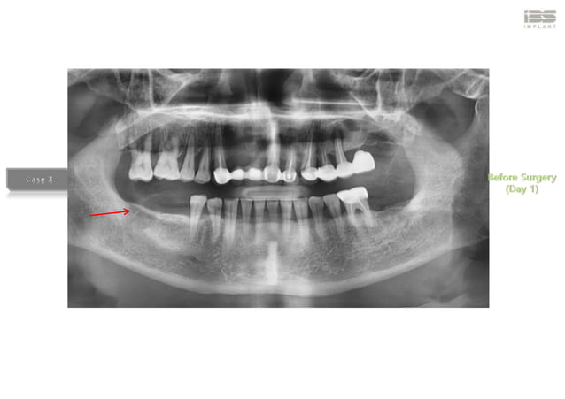 Magicore Clinical Cases. | PPTX | Dental Health | Diseases and Conditions