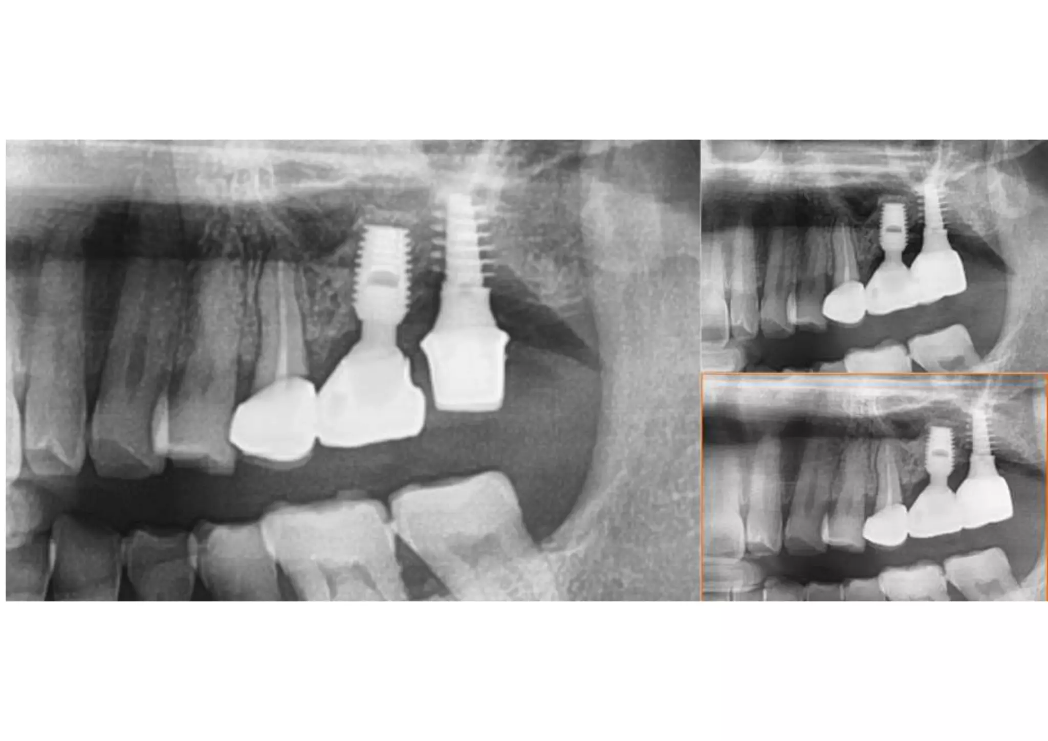 Replacement with Magicore due to severe resorption with other system | PPTX