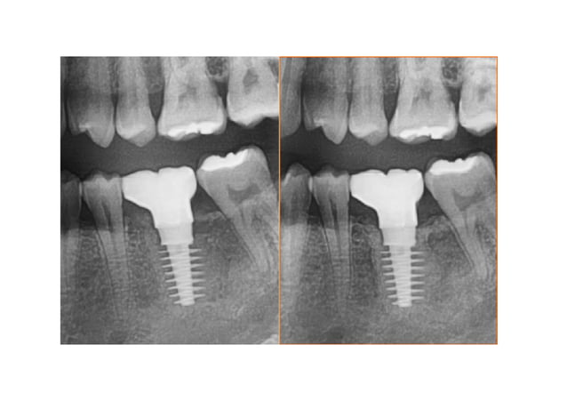 Replacement with Magicore due to severe resorption with other system | PPTX