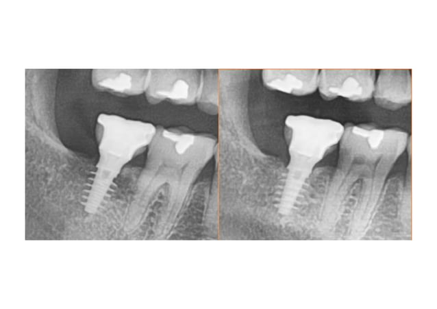 Replacement with Magicore due to severe resorption with other system | PPTX