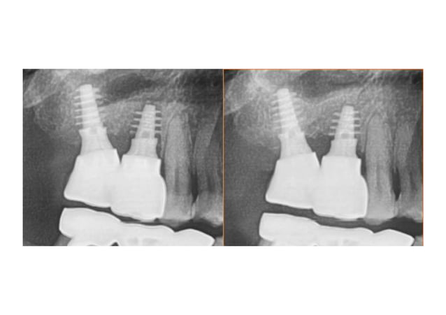 Replacement with Magicore due to severe resorption with other system | PPTX