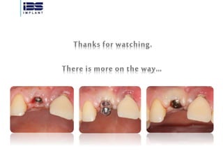 Replacement with Magicore due to severe resorption with other system | PPTX