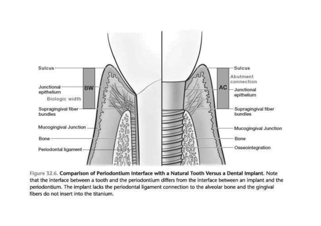 Replacement with Magicore due to severe resorption with other system | PPTX
