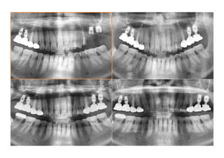 Replacement with Magicore due to severe resorption with other system | PPTX