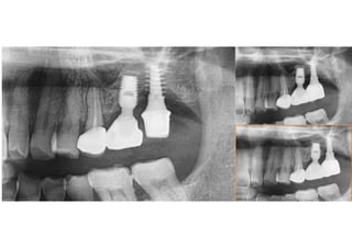 Replacement with Magicore due to severe resorption with other system | PPTX