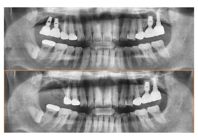 Replacement with Magicore due to severe resorption with other system | PPTX