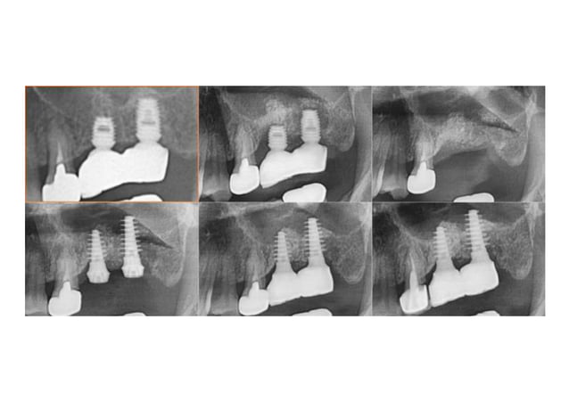 Replacement with Magicore due to severe resorption with other system | PPTX