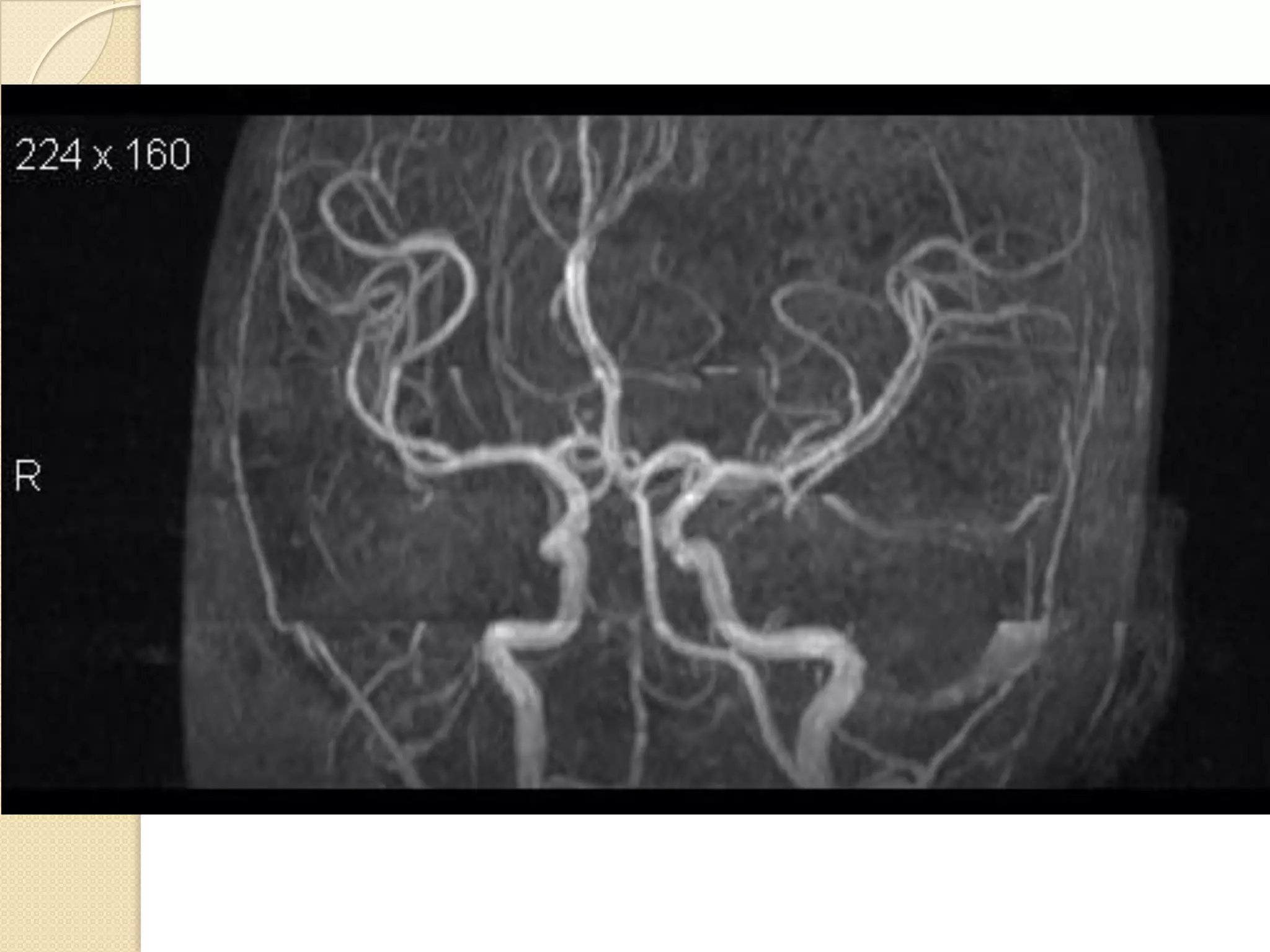 Magnetic resonance angiography | PDF