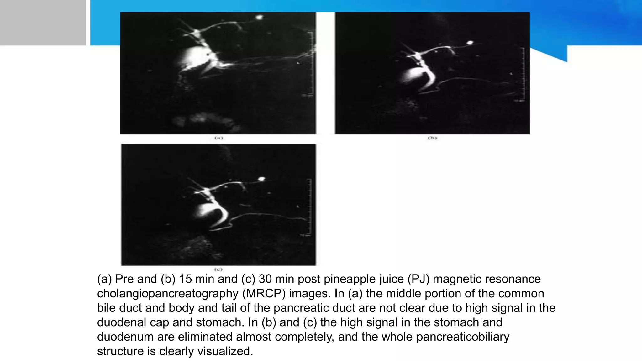 Magnetic resonance cholangiopancreatography ppt | PPTX