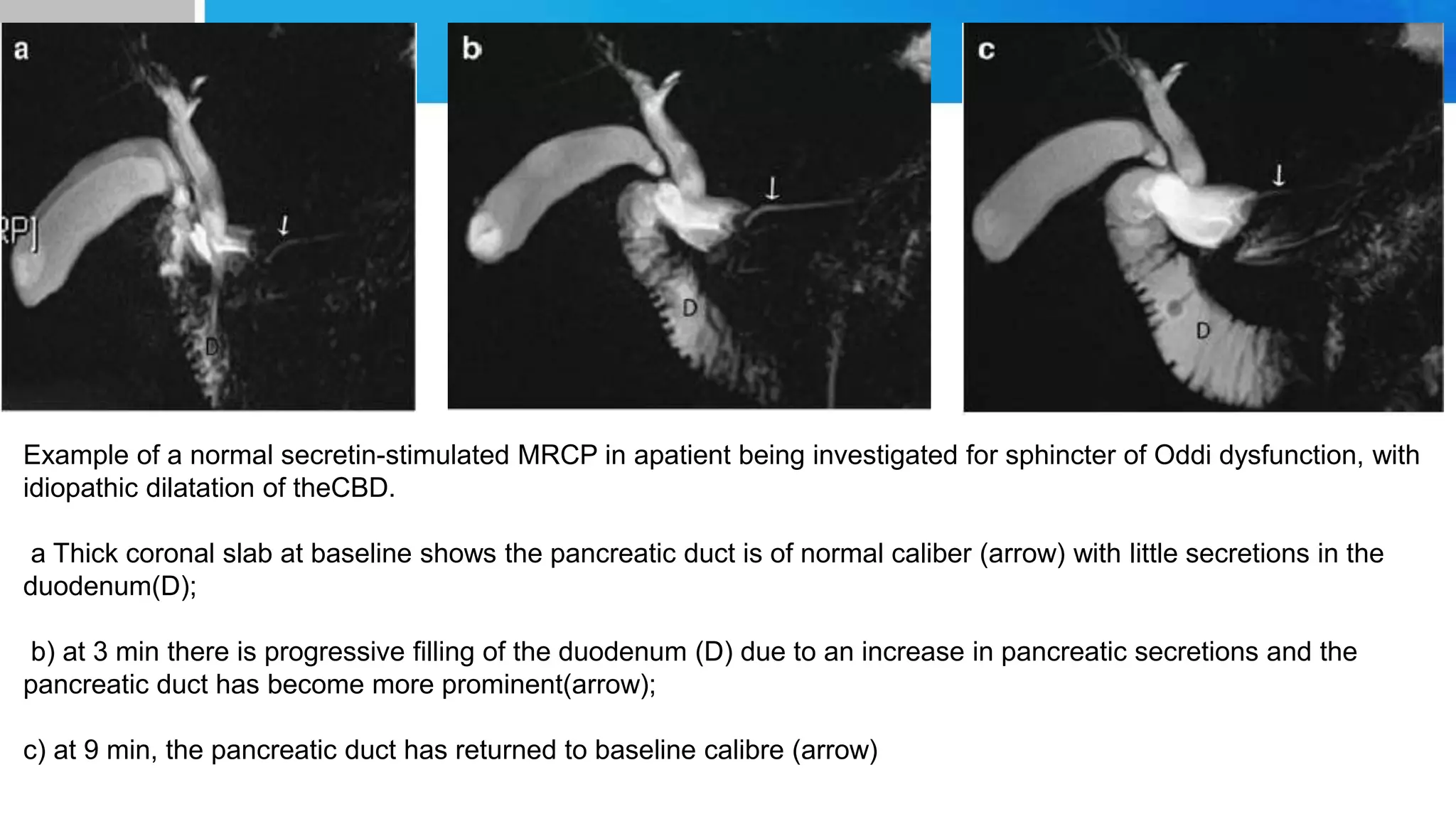 Magnetic resonance cholangiopancreatography ppt | PPTX