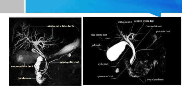 Magnetic resonance cholangiopancreatography ppt | PPTX