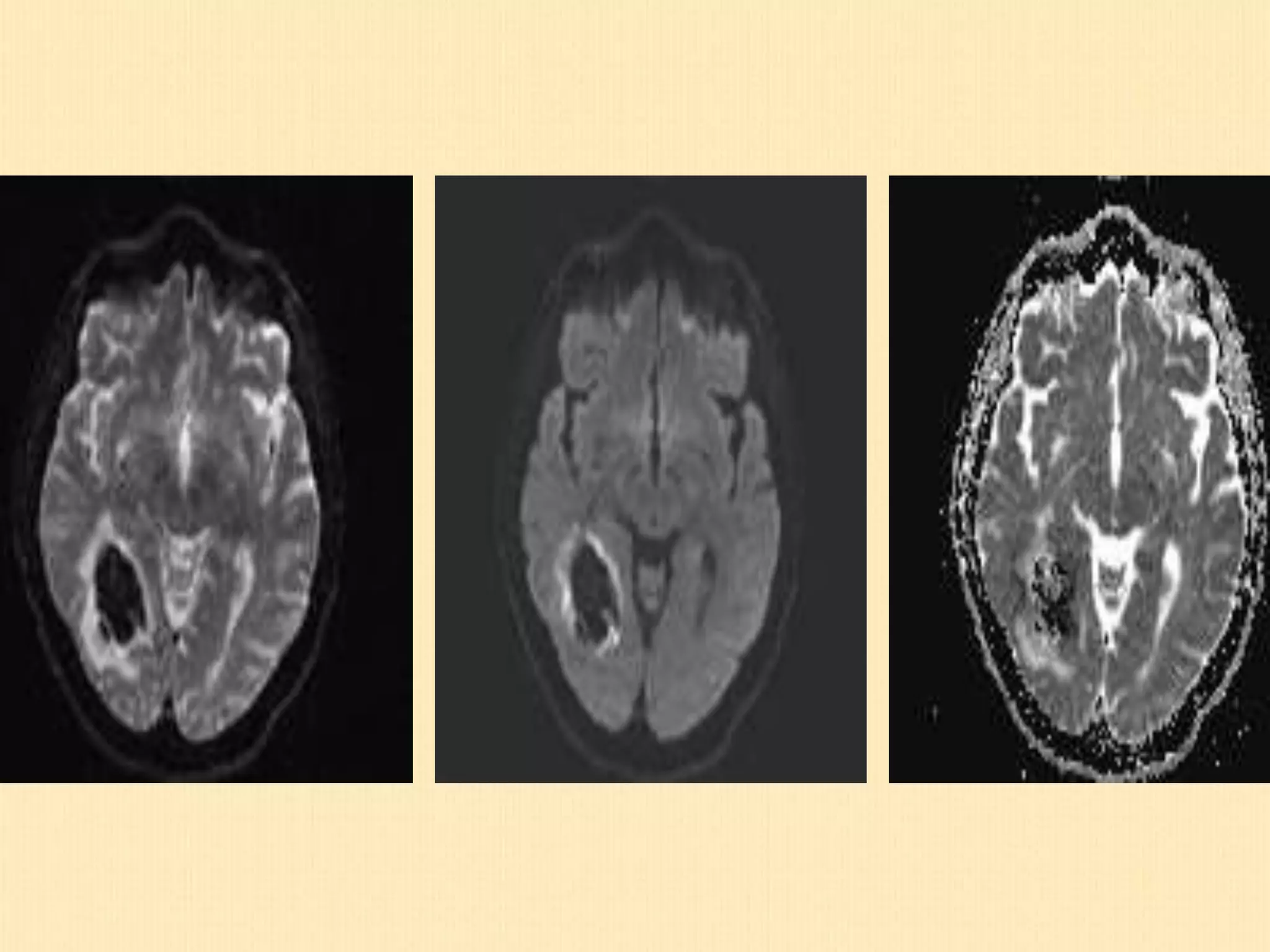 Magnetic Resonance Diffusion Weighted Imaging | PPT