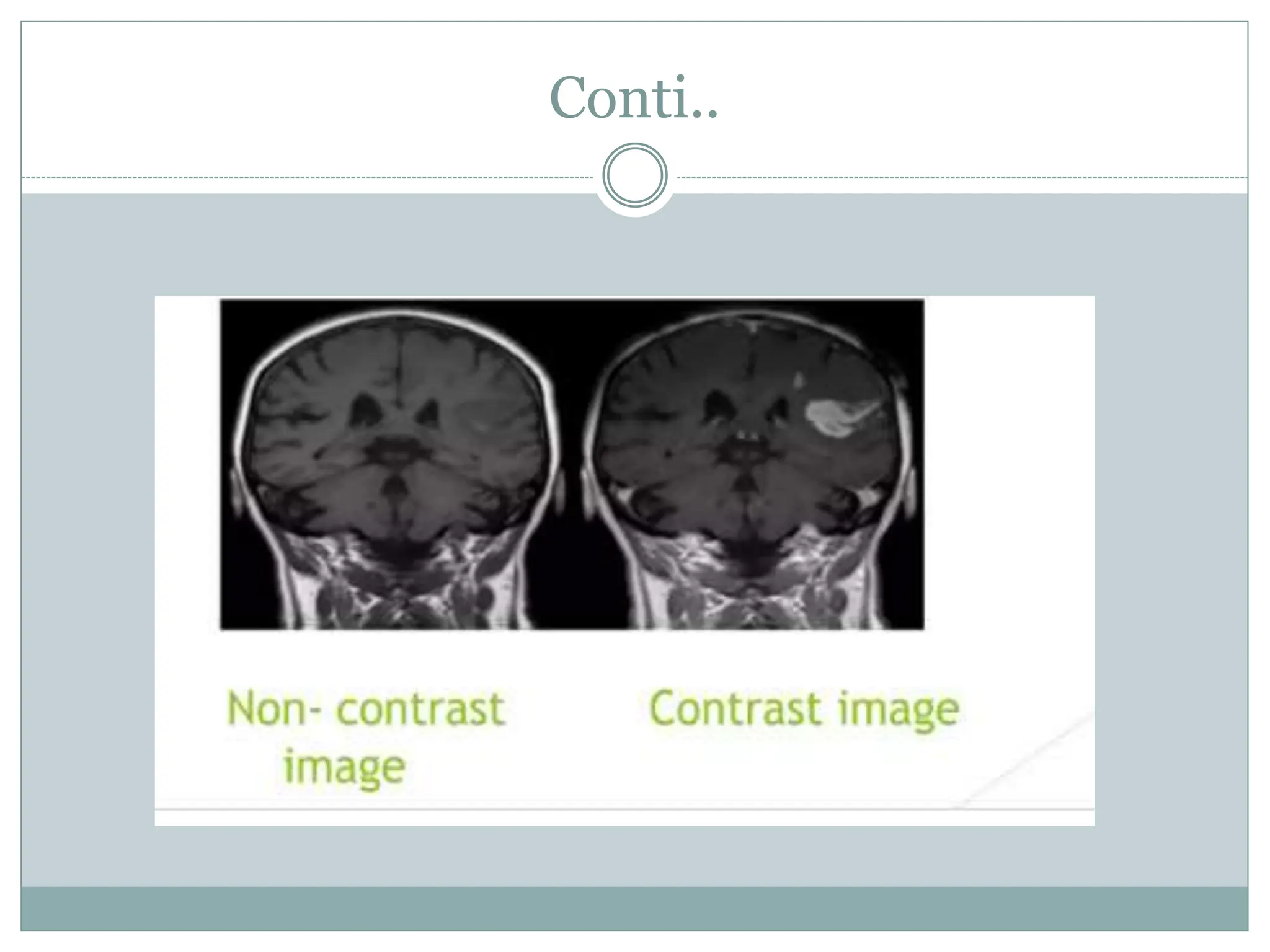 Magnetic Resonance Imaging Brain (MRA).pptx,umour, Metastases Cranial nerve lesion, Cavernous ...