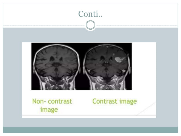 Magnetic Resonance Imaging Brain (MRA).pptx,umour, Metastases Cranial nerve lesion, Cavernous ...
