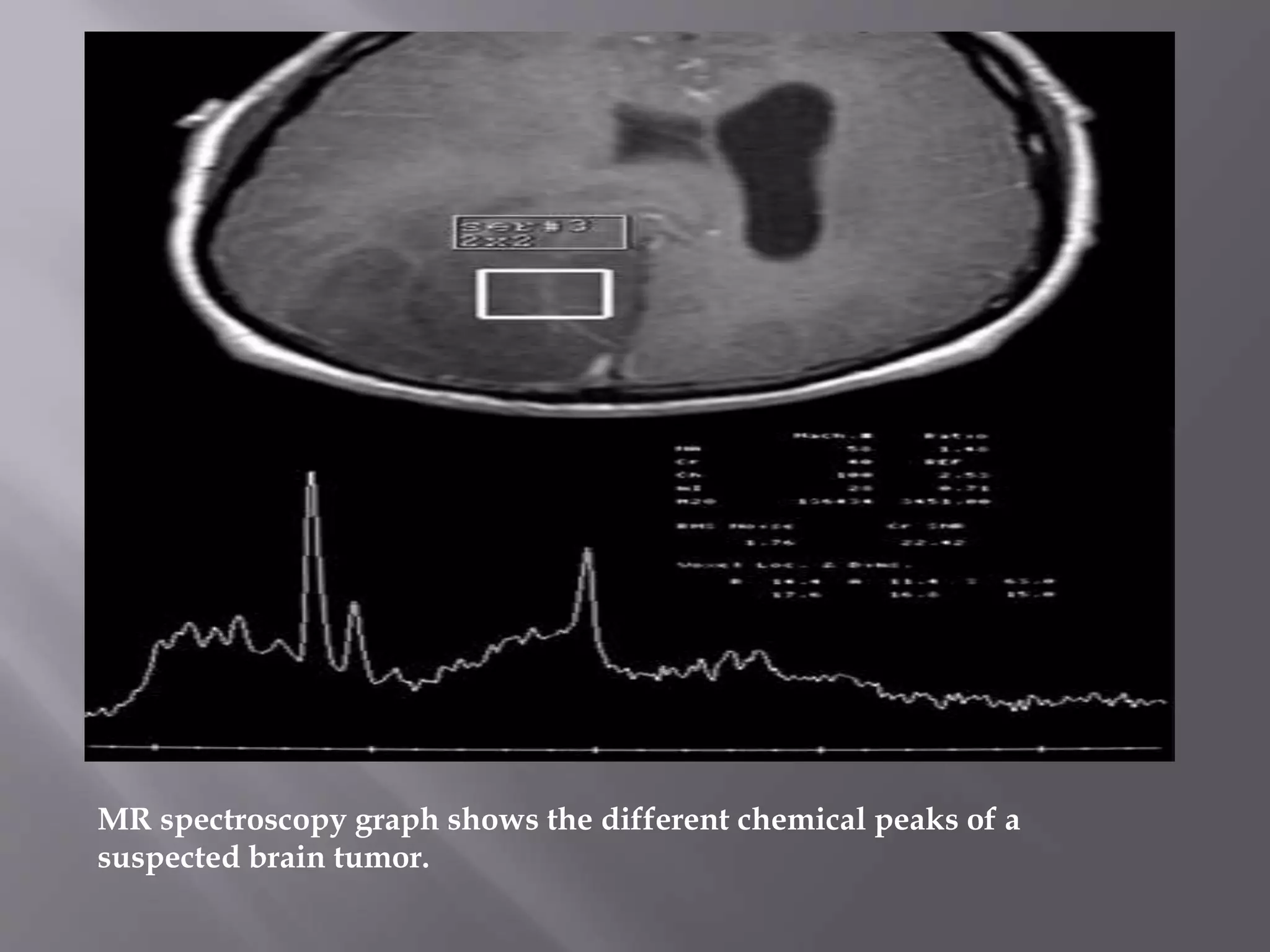 Magnetic_Resonance_(MR)_spectroscopy-1.pptx