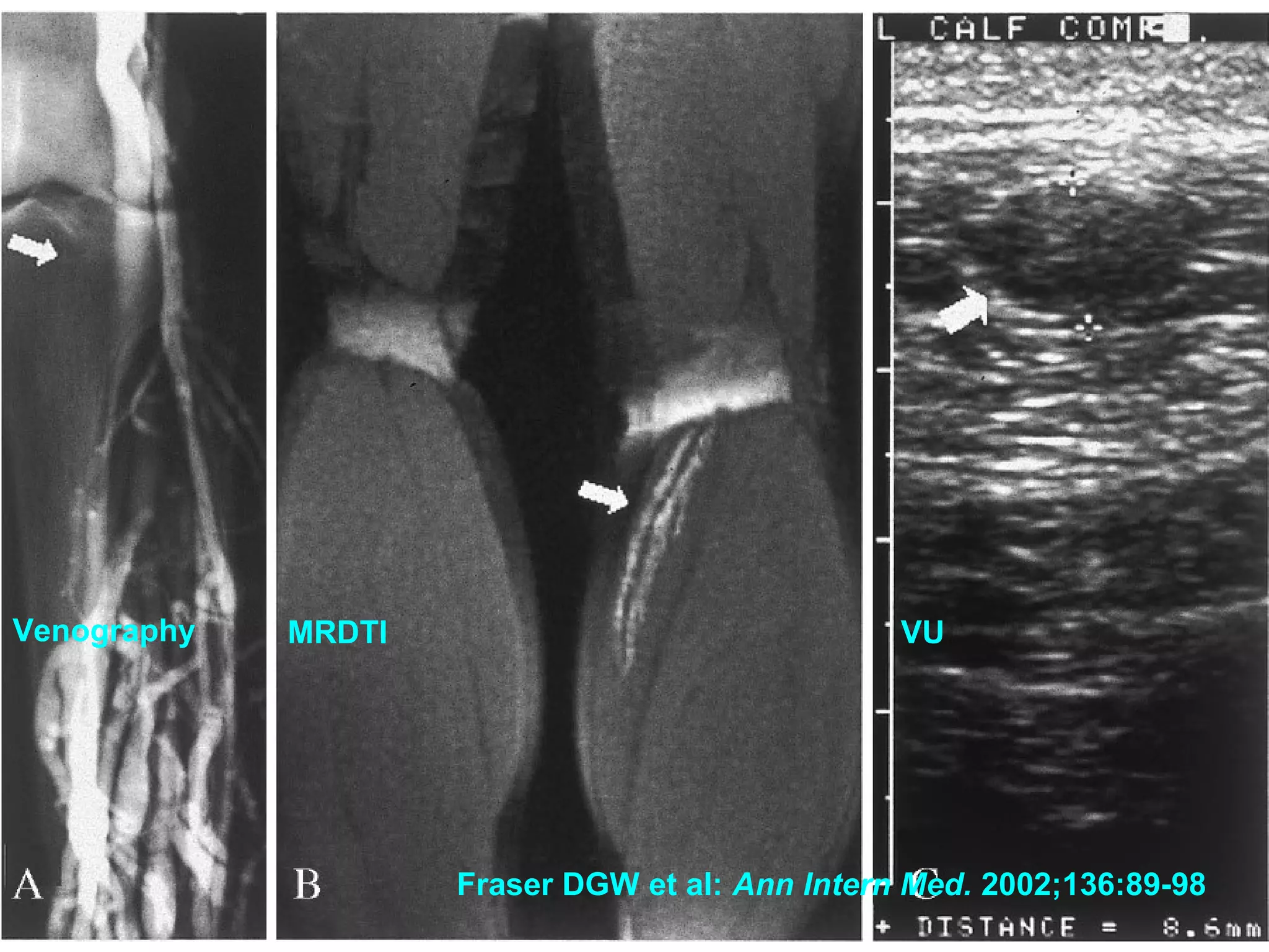 Magnetic resonance venography & venous ultrasosnography for diagnosisng ...
