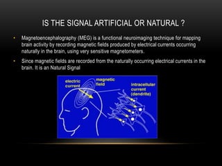 Magnetoencephalogram-MEG | PDF