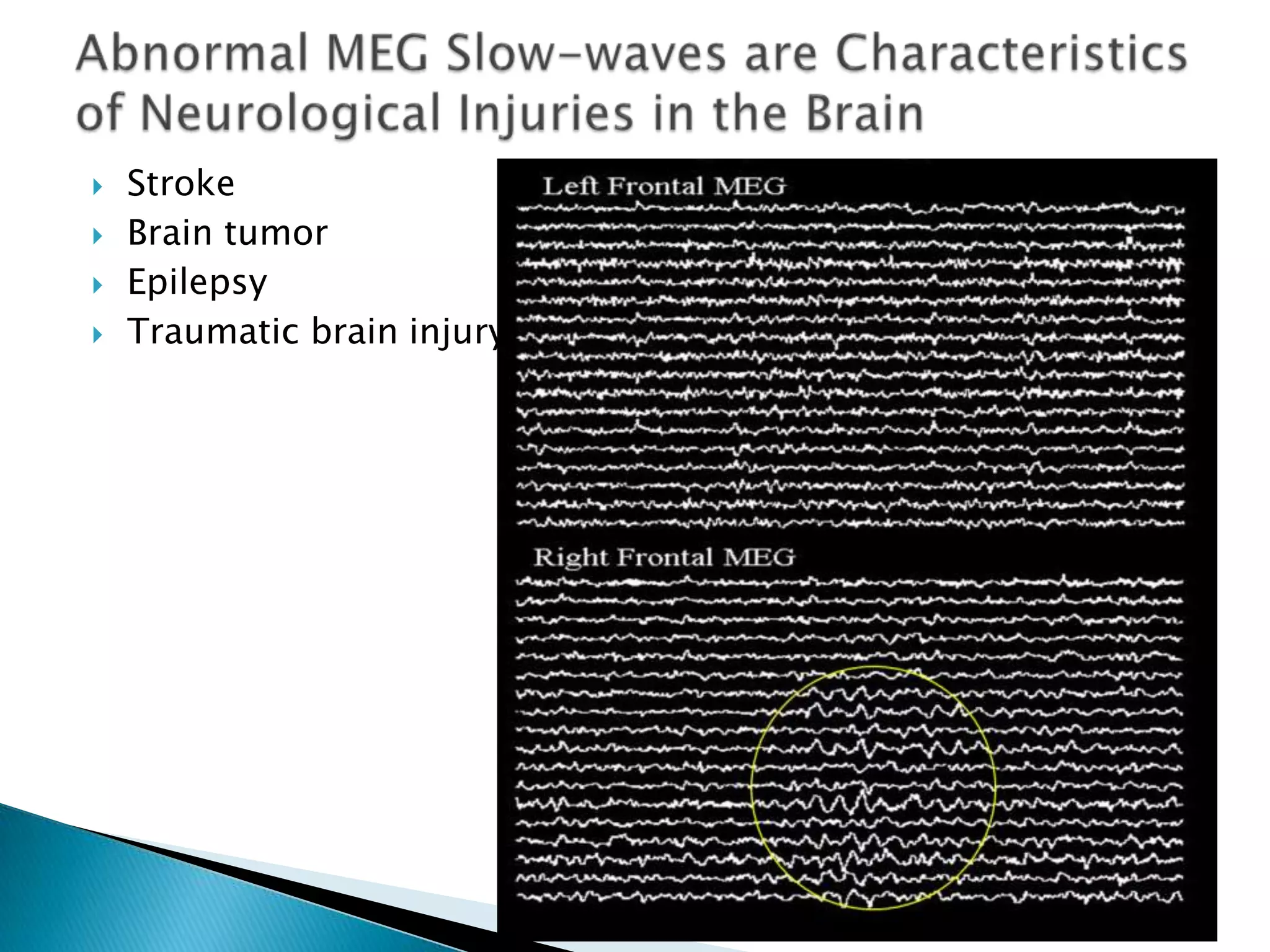Magnetoencephalography (meg) and diffusion tensor imaging | PPTX ...