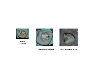 Magnification in endodontics | PPTX